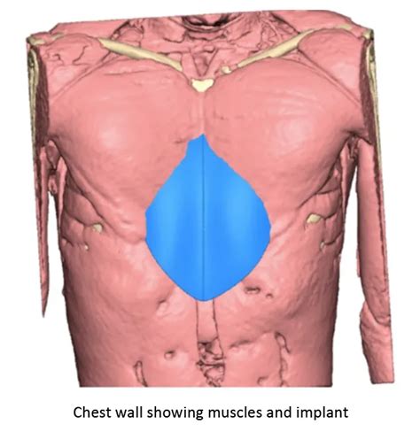 Result After Pectus Implant For Severe Pectus Excavatum Pectus Clinic