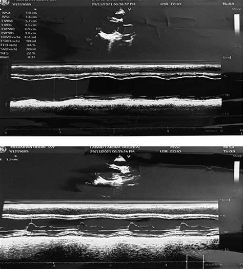 A And 5b Measurement Of Lvef In The Image Above Fig 5a And Epss In The Download Scientific