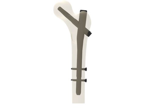 Proximal Femoral Nail Antirotation