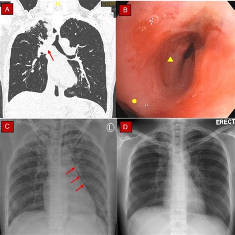 Computed Tomography Ct And Serial Bronchoscopy Images A Ct