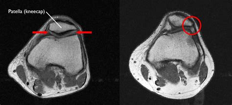 Anterior Knee Pain Syndrome