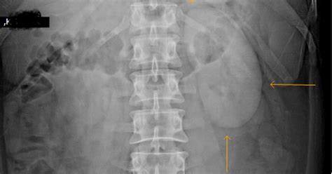 Dense Persistent Nephrogram Causes Sumers Radiology Blog