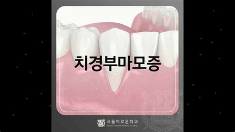 치경부마모증 치아가 패여 시리다면 네이버 블로그