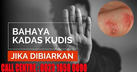 Kumpulan Cara Mengobati Gatal Gatal Di Seluruh Tubuh Secara Alami