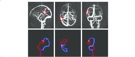 4dflow Mri Cartography Of A Right Parietal Brain Avm Top Row