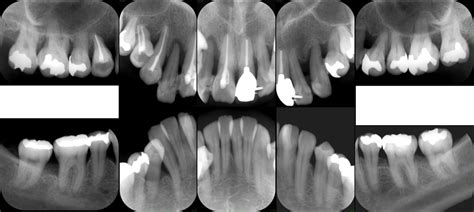 Severe Periodontitis Radiograph