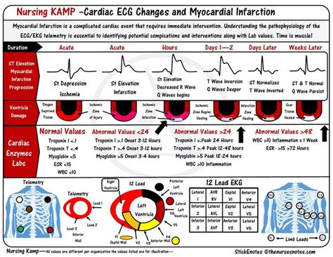 Stemi Myocardial Infarction พยาบาล ความรู้ ห้องสมุด
