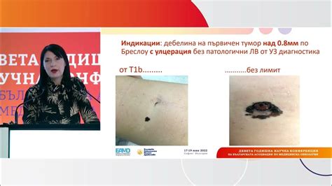 Онкофертилитет при пациенти с малигнен меланом д р Гаврилова Youtube