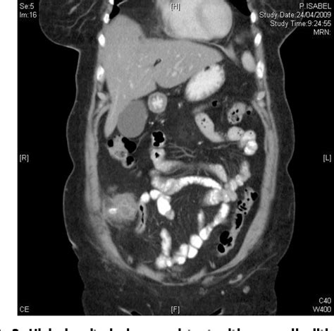 Pdf Laparoscopic Resection Of Appendicular Stump After Recurrent