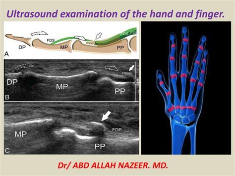Presentation1pptx Ultrasound Of The Hand And Fingers Pptx