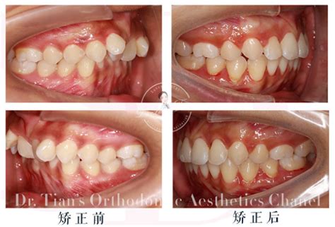 郑州牙齿矫正 牙齿矫正 隐适美「矫正后牙齿排列良好，覆合覆盖纠正，容貌美丽」 哔哩哔哩