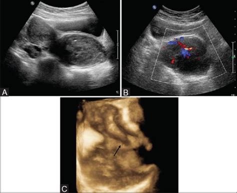 Multimodality Imaging Of Vaginal Rhabdomyosarcoma Abstract Europe PMC