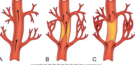 Patients With Coronary Artery Disease Cad Flashcards Quizlet