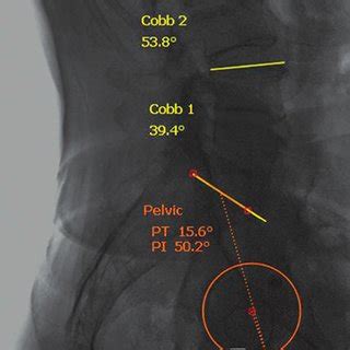 Surgimap Tools Cobb Angle And Pelvic Parameters Fig 3 Measurement Of