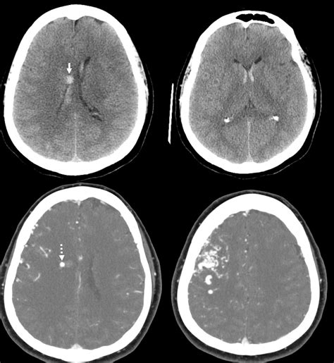 Ruptured Brain Avm Perinidal Lenticulostriate Aneurysm Nbca