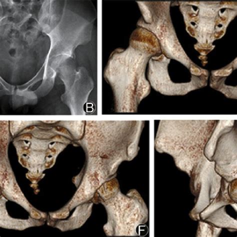 A 24 Year Old Male Patient With Left Pipkin Iv Type Femoral Head Download Scientific Diagram