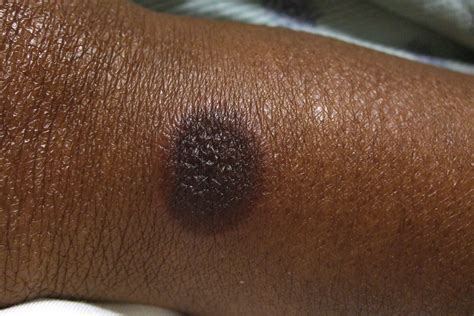 Fluoroquinolone Induced Generalized Fixed Drug Eruption
