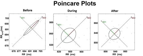 Nonlinear Hrv Analysis By Successive R To R Intervals As Analyzed In