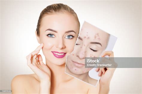 Pimpled 피부와 깨끗 한 피부 지주 초상화와 여자의 근접 촬영 초상화 가꿔주기에 대한 스톡 사진 및 기타 이미지 가꿔