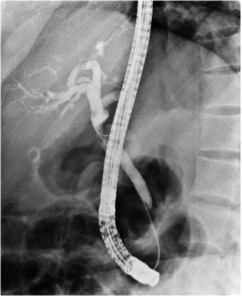 A Stricture Just Distal To The Common Hepatic Duct Confluence And