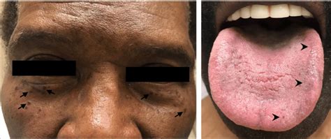 New Onset Hyperpigmented Macules Below The Eyes Arrows And Lateral New Onset Hyperpigmented Macules Below The Eyes Arrows And Lateral