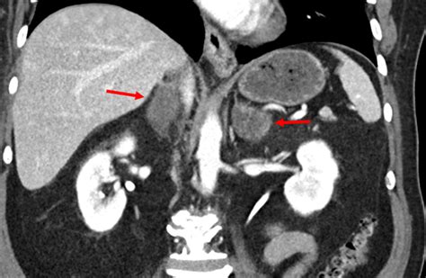 An Unexpected Culprit Cryptococcus Induced Adrenal Insufficiency In An