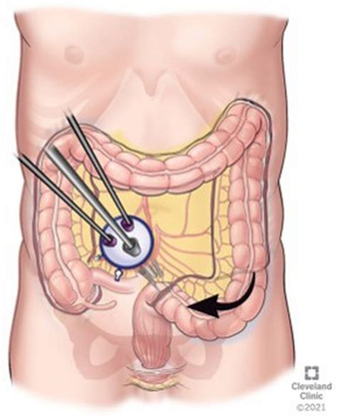 Dissection Is Proceeded To The Rectosigmoid Junction Download Scientific Diagram