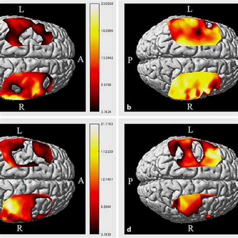 Pdf Low Frequency Rtms And Intensive Occupational Therapy Improve Upper Limb Motor Function