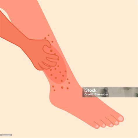 플랫 디자인으로 다리를 긁는 손 강한 알레르기 피부 가려운 증상 개념으로 고통받는 남자 또는 여성 붉은 발진 피부 자극 다리 신체 부분에 대한 스톡 벡터 아트 및 기타