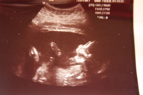 Calculate Due Date Using Ultrasound At Elaine Osborn Blog