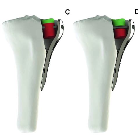 Four Subtypes Of Fracture After Assembly A D Respectively