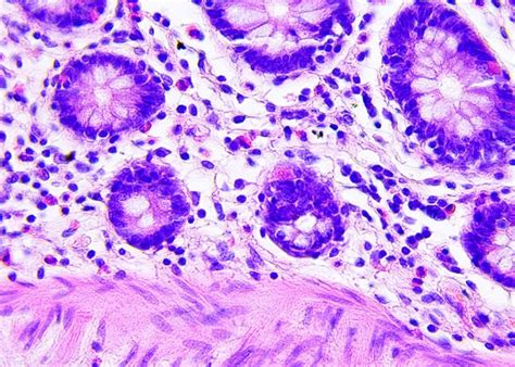 APC Protein Affects Immunity By Preventing Pre Cancerous Inflammation