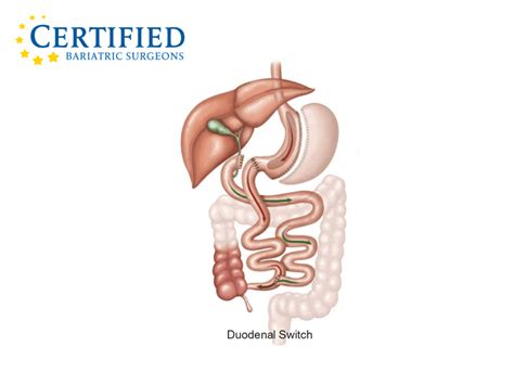Duodenal Switch Surgery Certified Bariatric Surgeons