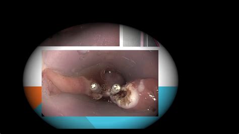 Endoscopic Treatment Of Zenker Diverticulum Russells Hall Hospital