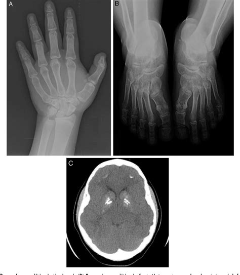Figure 2 From Clinical And Radiological Findings In A Case Of