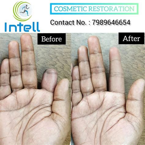 Silicone Finger Prosthesis Cable Operated At ₹ 14000 Piece In