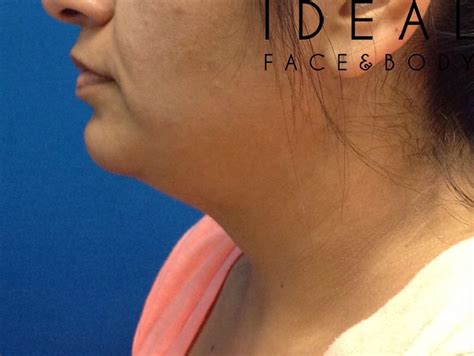 Chin And Neck Ideal Face And Body