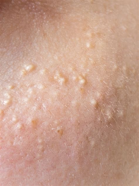 How To Make A Bump On Your Nose Go Away At Maria Couch Blog
