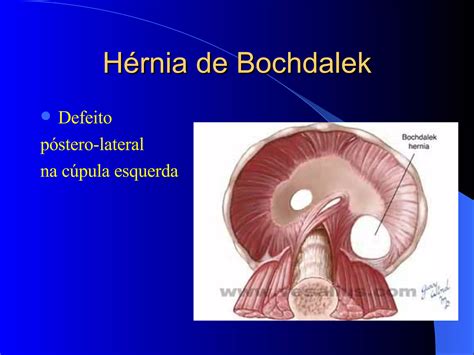 Hernia Diafragmatica Congenita Ppt Lung And Respiratory Health