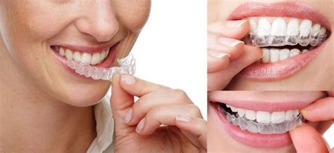 Invisalign o aparelho transparente móvel da atualidade