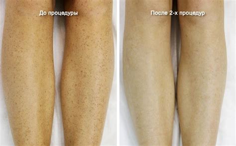 Пигментные пятна на ногах у мужчин и женщин что делать