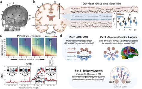Epilepsy Brain Activity