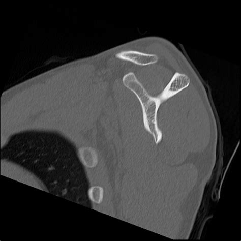 Normal Ct Shoulder Radiopaedia 60106 67676 Sagittal Bone Window Nc