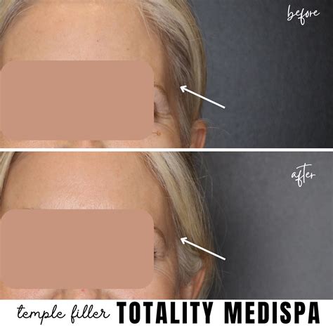 Temple Filler Before After Photos Patient 2 Totality Medispa