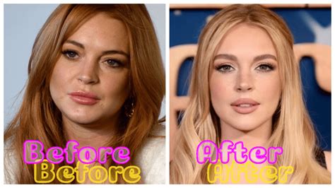 Lindsay Lohans Plastic Surgery Journey From Disney Darling To