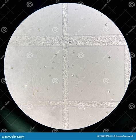 Dysmorphic Urinary Rbcs Have Been Regarded As An Indicator Of