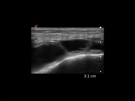 Knee Effusion Clarius