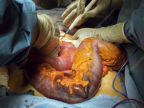 Megacolon Resection In Ischaemic Colitis Stock Image C029 6314 Science Photo Library