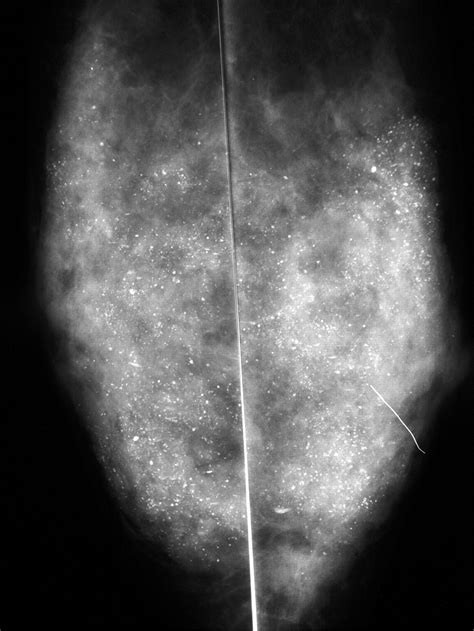 Calcification In Breast Lesions Pathologists Perspective Journal Of Clinical Pathology