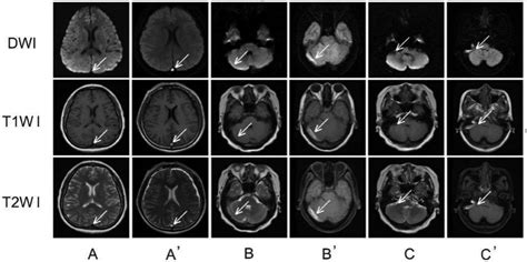 Normal Superior Sagittal Sinus A Transverse Sinus B And Sigmoid